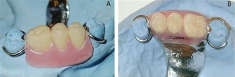 Esthetic Clasp Design For Removable Partial Dentures On Premolar Teeth
