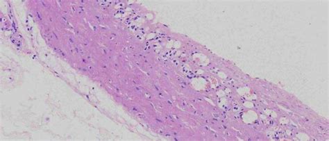 Histopathology Report Shows A Flattened Lining With Adjacent Normal