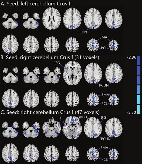 Group Differences In Seed Based Resting State Fc A Compared To Download Scientific Diagram