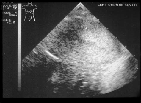 Bicornuate Or Septate Uterus Part 2 Alabama Fertility