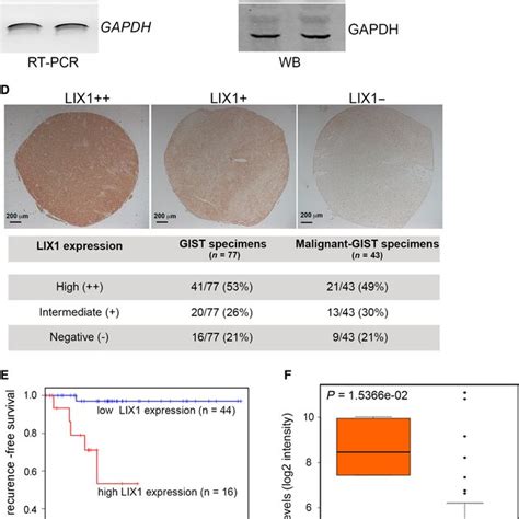 Lix1 Is Expressed In Gist Samples And The Gist‐t1 Cell Line A