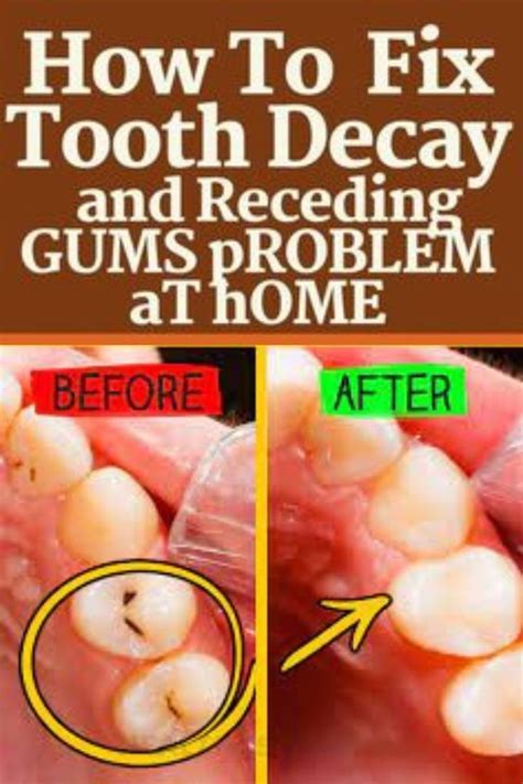 Oral Care Tooth Decay Cure Remove Receding Gums Artofit