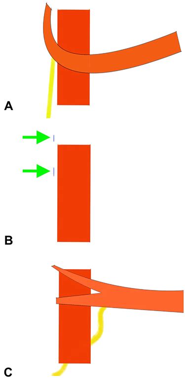 Novel Inferior Oblique Muscle Y Splitting Procedure To Minimize The An