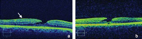 Functional And Structural Assessment Of Lamellar Macular Holes