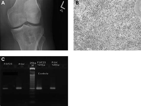 Chondromyxoid Fibroma Presenting In The Proximal Tibia As A Small Download Scientific Diagram