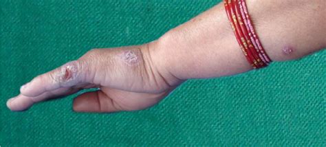 Nodulo Ulcerative Lesions Along The Lymphatics Over The Hand And Download Scientific Diagram