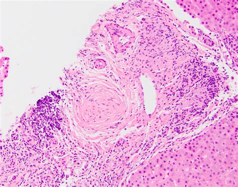 Pathology Outlines Primary Sclerosing Cholangitis