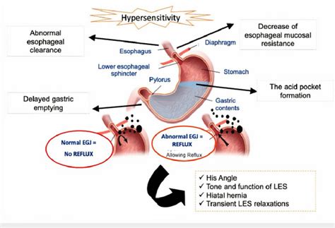 The Complex Pathogenesis Of Gerd Egj Esophagogastric Junction Les
