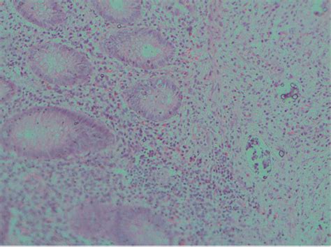 Histological Section Of Appendix He Stain Infiltration Of