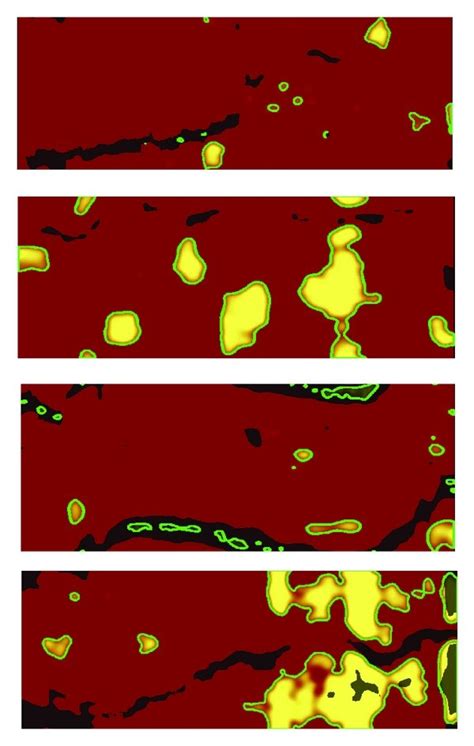 Segmentation Of The Lipid Core Plaque Areas A Detection Of The Download Scientific Diagram