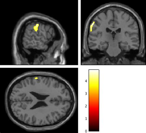 Decreased Gray Matter Regions In Eps Patients Compared With Ep Download Scientific Diagram