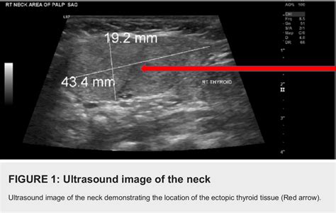 Figure 1 From Benign Ectopic Thyroid Tissue In The Neck A Case Report