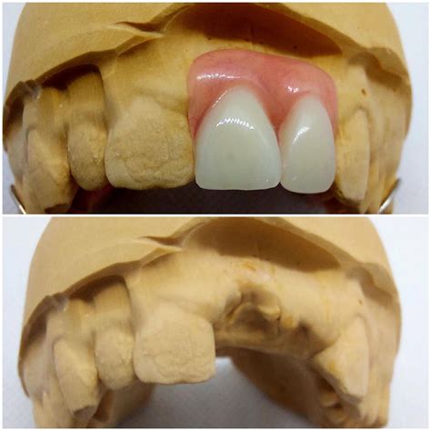 Acrylic Partial Denture Flipper Vida Smile Care