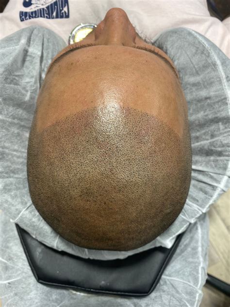 Scalp Micropigmentation Near Tampa Airport