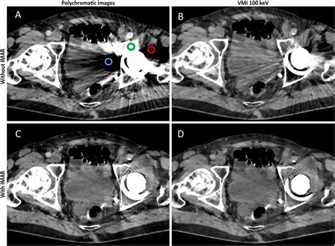 Representative Axial Polychromatic Image A Virtual Monoenergetic Download Scientific Diagram