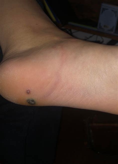 Bleomycin Plantar Wart Treatment Medicaladvice