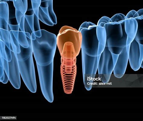 임플란트 엑스레이 보기로 조발치 치아 회복 인간의 치아와 의치 개념의 의학적으로 정확한 3d 그림 건강관리와 의술에 대한 스톡