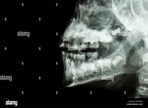 Jaw X Ray Image At Edith Corlett Blog