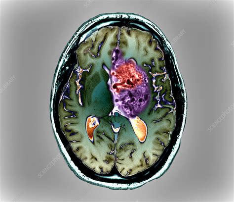 Subarachnoid Hemorrhage Mri Scan Stock Image C055 1834 Science Photo Library