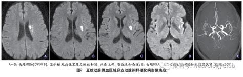 【共识】中国穿支动脉粥样硬化病专家共识治疗bad动脉研究患者 健康界
