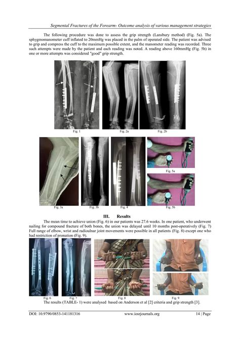 Segmental Fractures Of The Forearm Outcome Analysis Of Various Management Strategies Pdf