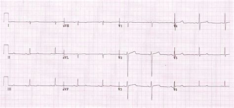 Erratic Emedicine ECG Axis Deviation The Normal Axis Of The Heart