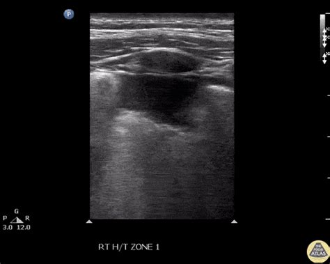 Consolidation Differential Diagnosis Of