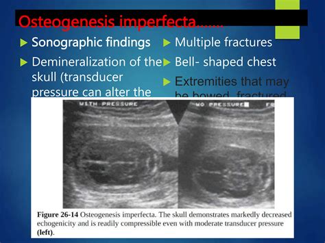 Fetal Skeletal Anomalies Group 3pptx