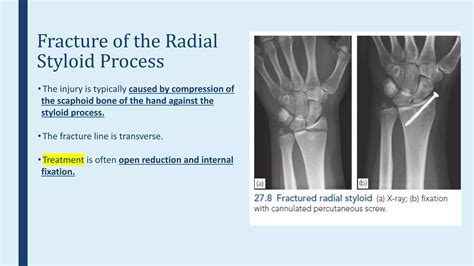 Upper Limb Fractures Pptx