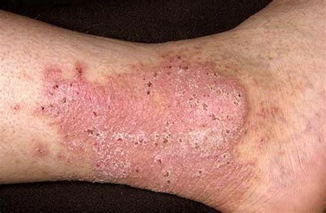 Lichen Simplex Chronicus Cause Symptoms Treatment By Dr Amey