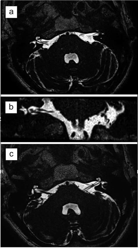 A Magnetic Resonance Image Of A Right Sided Type 3a Vascular Loop B Download Scientific