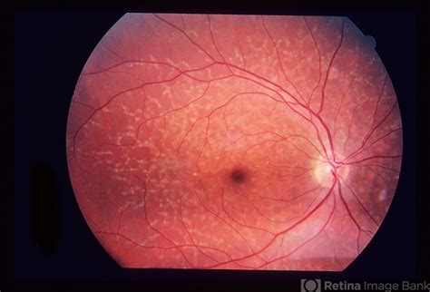 Reticular Pattern Dystrophy Retina Image Bank Reticular Pattern Dystrophy Retina Image Bank