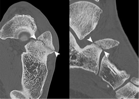 Axial Left And Sagittal Right CT Images The Arrowheads Demonstrate Download Scientific