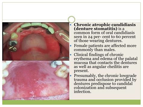 Candidiasis Pptx