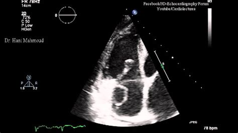 Left Atrial Appendage Echo