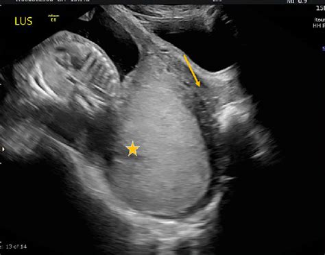 Longitudinal Trans Abdominal Ultrasound Image Of The Pelvis The Download Scientific Diagram