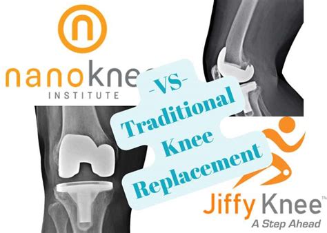 Nano Knee™ Jiffy Knee® Traditional Knee Replacement What Patients
