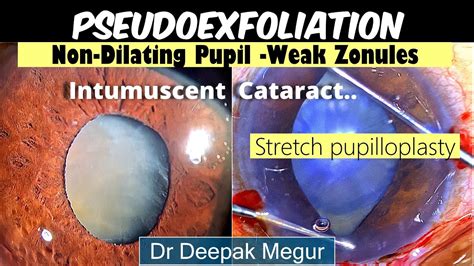 Phacoemulsification Pseudoexfoliation Poor Mydriasis Weak Zonules