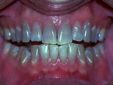 Endogenous Staining Of Teeth