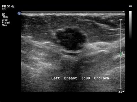Atlas Of Breast Cancer Early Detection
