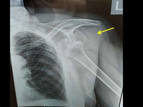 Neglected Shoulder Dislocation Management Pptx