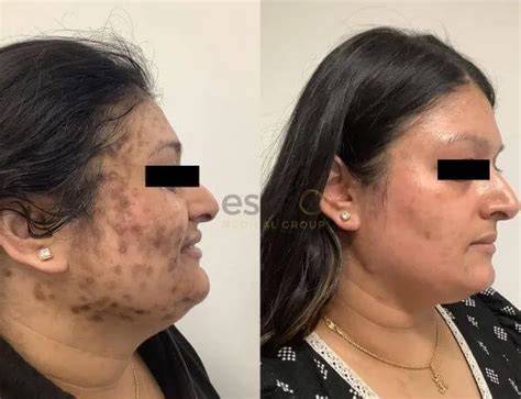 Cosmelan Peel Before And After Pigmentation Treatment Results Este