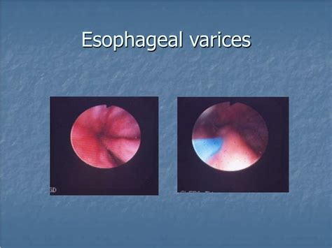 Ppt Gastrointestinal Bleeding Powerpoint Presentation Free Download