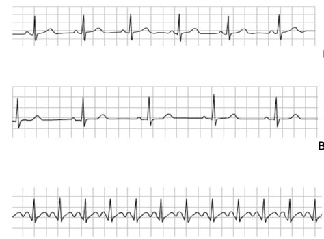 Ekg Diagram Diagram Quizlet