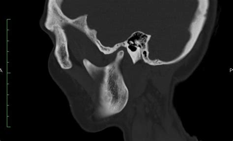 Glenoid Fossa Regeneration In Sagittal View Download Scientific Diagram