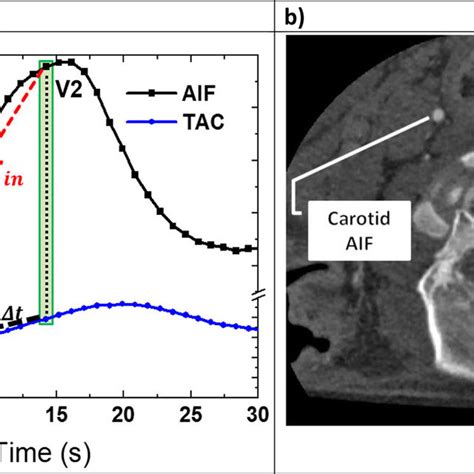 two volume ct perfusion measurement protocol a top curve arterial