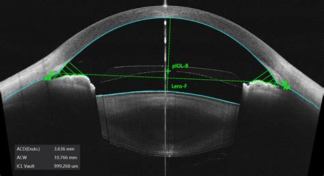 Anterior Segment Intalight