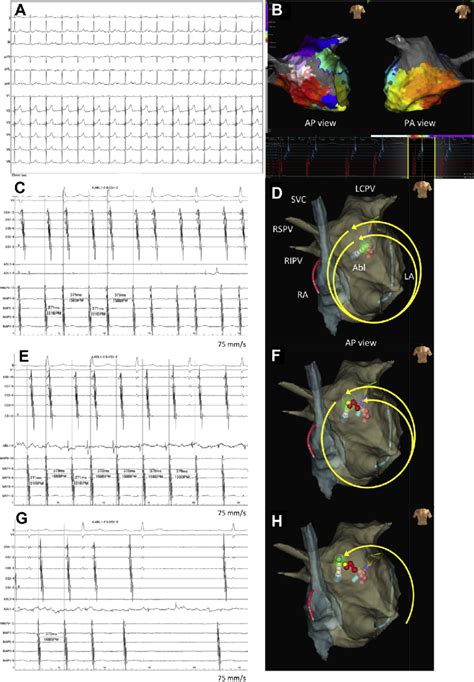 A The 12 Lead Electrocardiogram Of Atrial Flutter Afl With Download Scientific Diagram