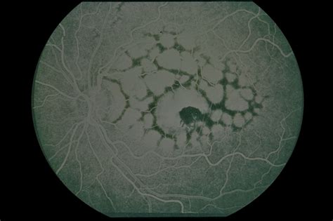 Reticular Pattern Dystrophy Retina Image Bank Reticular Pattern Dystrophy Retina Image Bank