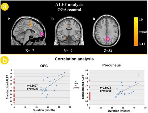 A Alff Differences Between Oga And Healthy Control Groups